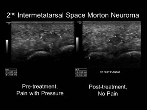 Morton's Neuroma Treatment Ultrasounds - Tucson's Podiatric Medicine ...