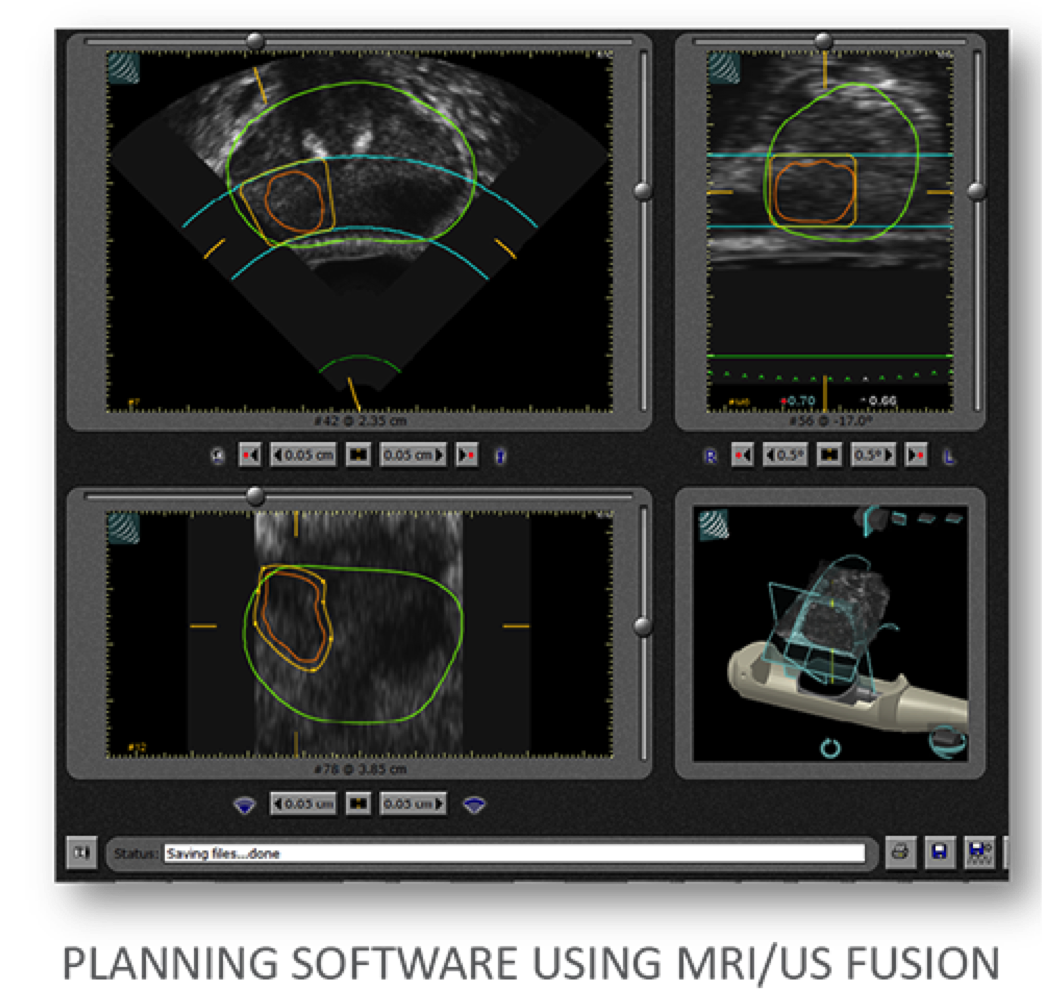 MRI Images Fused with Ultrasound - Prostate Cancer Treatment | HIFU For ...