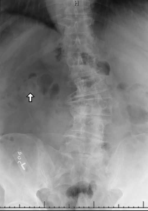 Pedicle Subtraction Osteotomy | Houston Scoliosis & Spine Institute