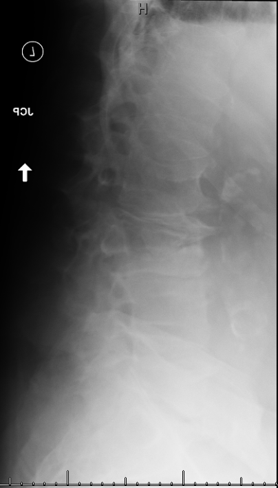 Pedicle Subtraction Osteotomy | Houston Scoliosis & Spine Institute