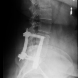 Revision Surgery after Failed Axialif | Houston Scoliosis & Spine Institute