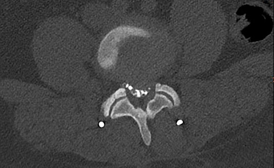 Revision Surgery after Failed Axialif | Houston Scoliosis & Spine Institute