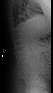Pedicle Subtraction Osteotomy | Houston Scoliosis & Spine Institute