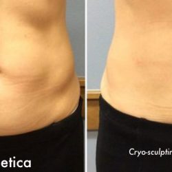 Cryo Body Sculpting – Modern Aesthetica – Santa Monica CA