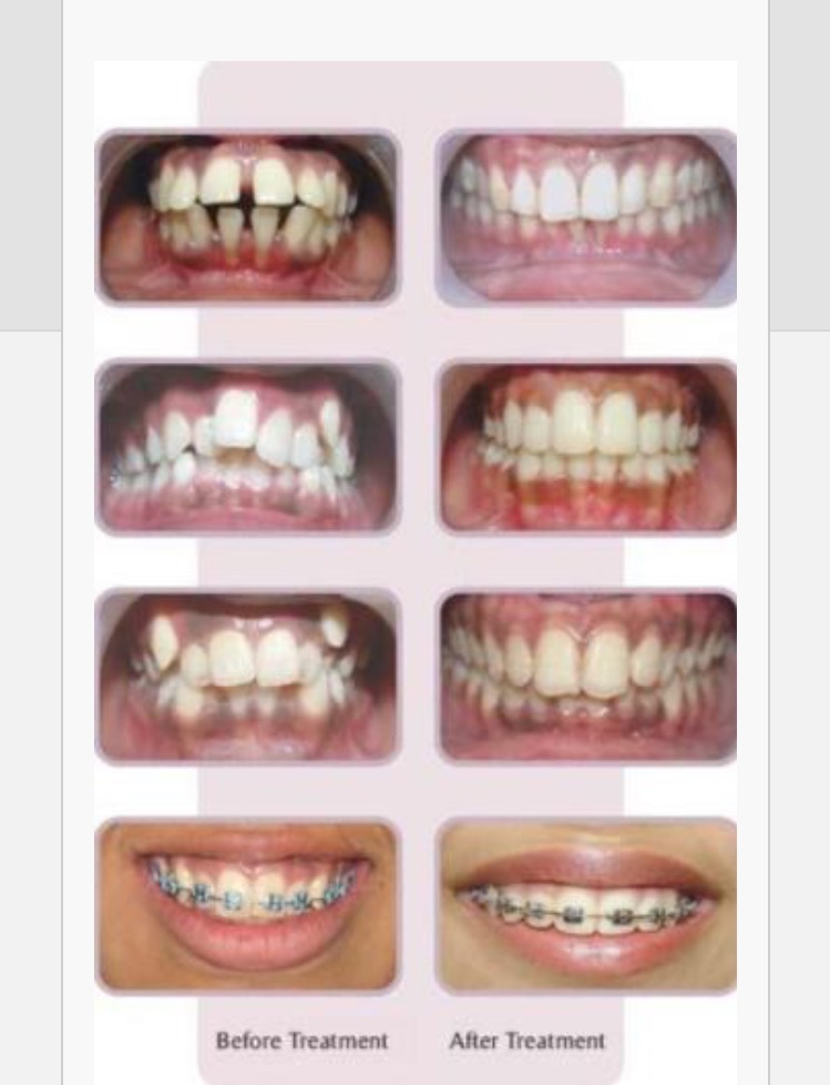 Before & After Gallery | Ortho One