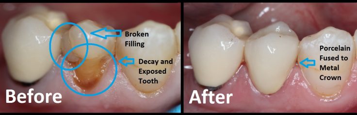 Crowns - Find Out About Our Crowns | Precision Dental Of Windsor